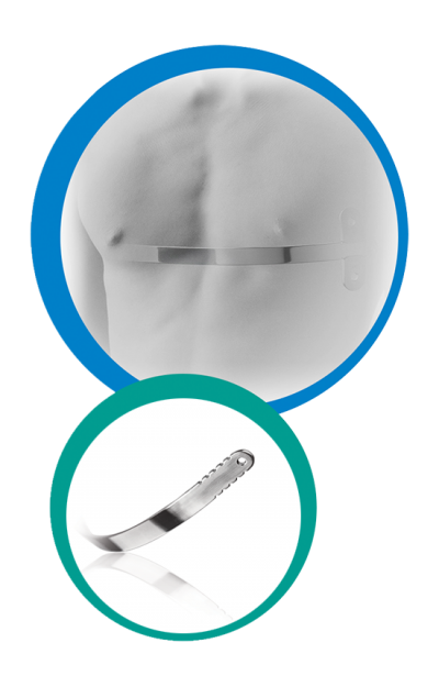 Pectus excavatum carinatum bar | Jubli Medik Sdn Bhd